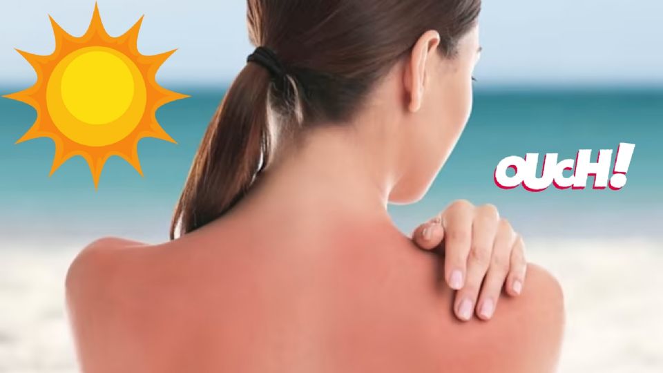 Remedio casero para aliviar las quemaduras provocadas por los rayos del ...